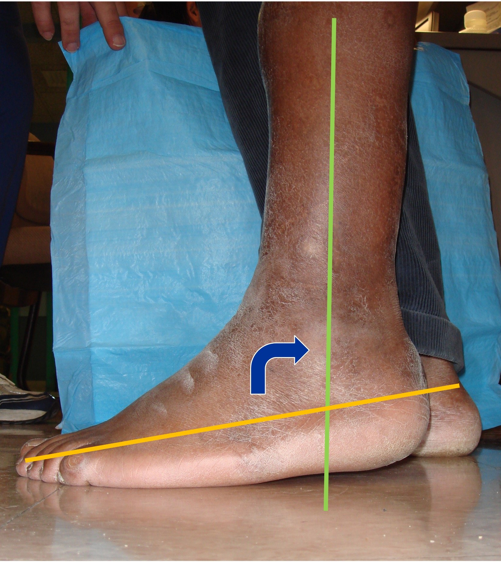 Equinus Toe Fort Lauderdale, Florida | Ankle Surgeon New York